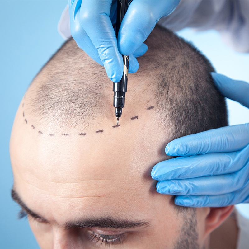 Hair transplant without shaving in Turkey | Mira Clinic