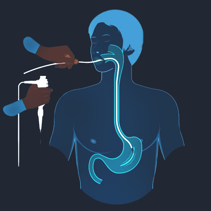 Endoscopic Sleeve Gastroplasty in Turkey | Mira Clinic