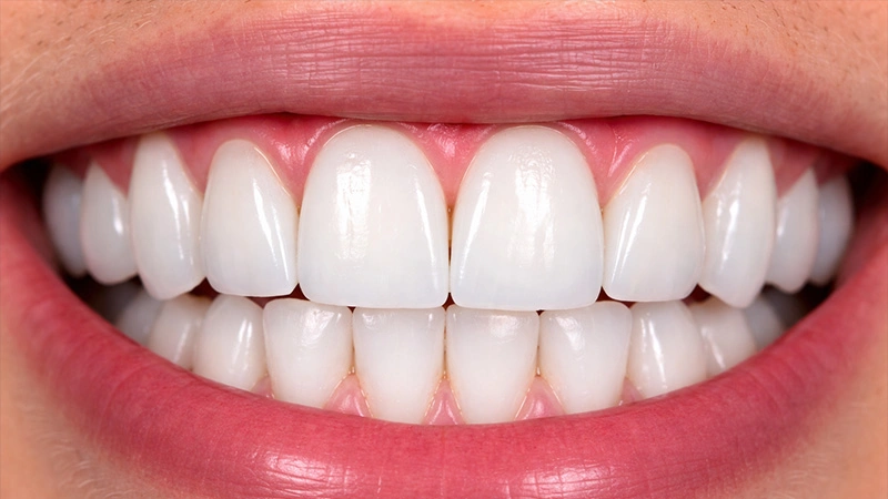 Why Do Some Veneers Look Fake, Big, or Bulky in Turkey? What Actually ...