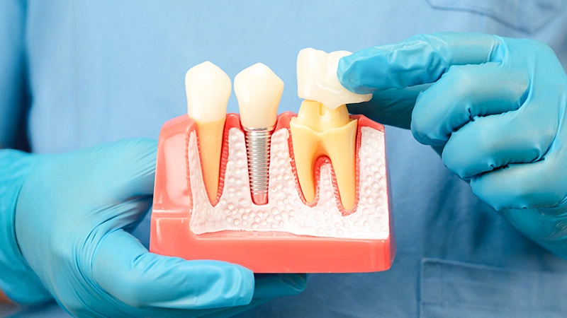 Mira Clinic | Smile Makeover vs Hollywood Smile in Turkey (2026): What ...