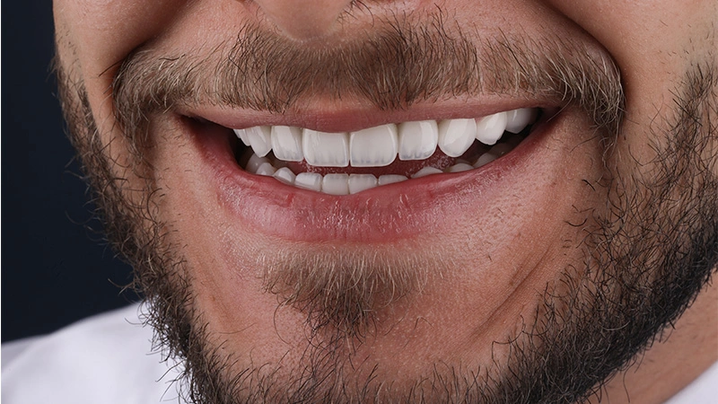 Mira Clinic | Hollywood Smile in Turkey 2026 | Cost, Procedure & Design ...