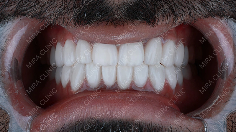 Do Veneers Damage Teeth? What Really Happens to Enamel and Tooth Prep ...